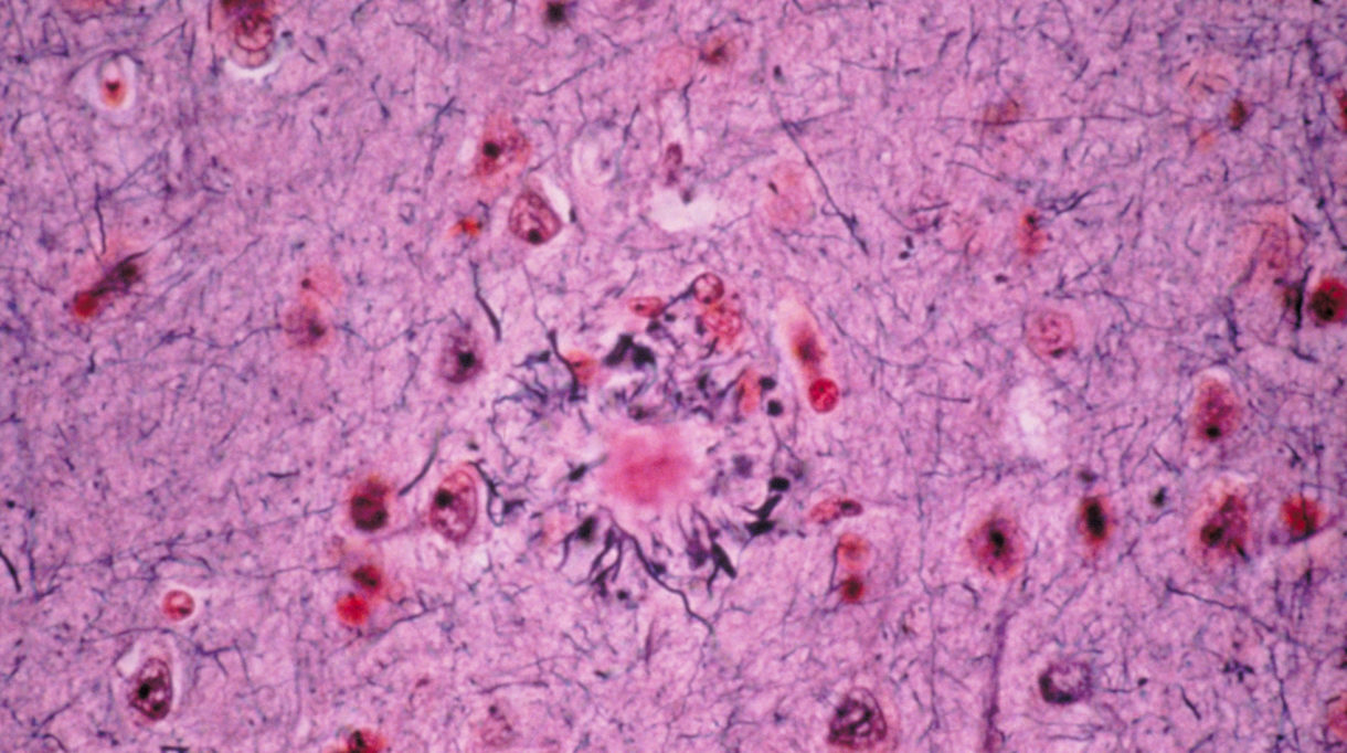 This light micrograph of a part of a brain affected by Alzheimer's ...